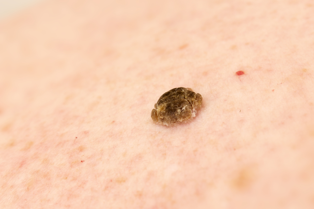 Keratosis: Growths on the Skin That Can Be Dangerous