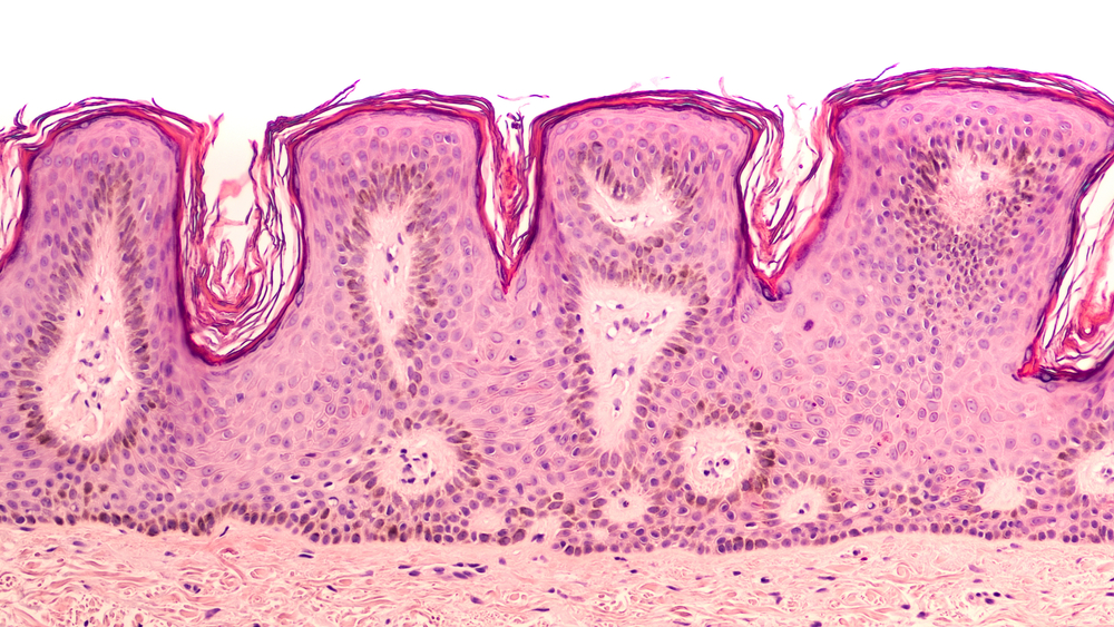 What is Hyperkeratosis? - Redorbit